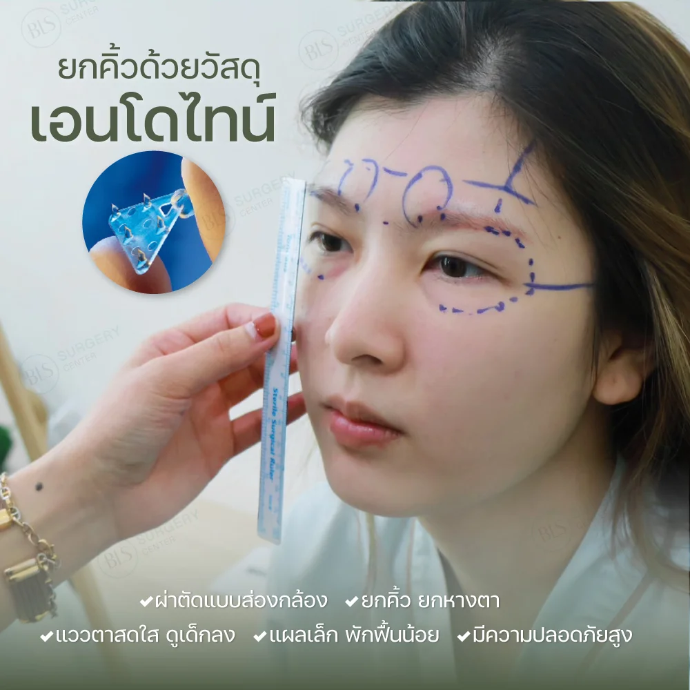 เหตุผลที่ควรทำ เอนโดไทน์ คือ อะไร? ข้อดี-ข้อเสีย - Dr.Beam